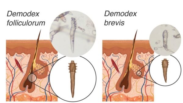 Demodex Mites on Humans: Symptoms, Causes, and Effective Treatments