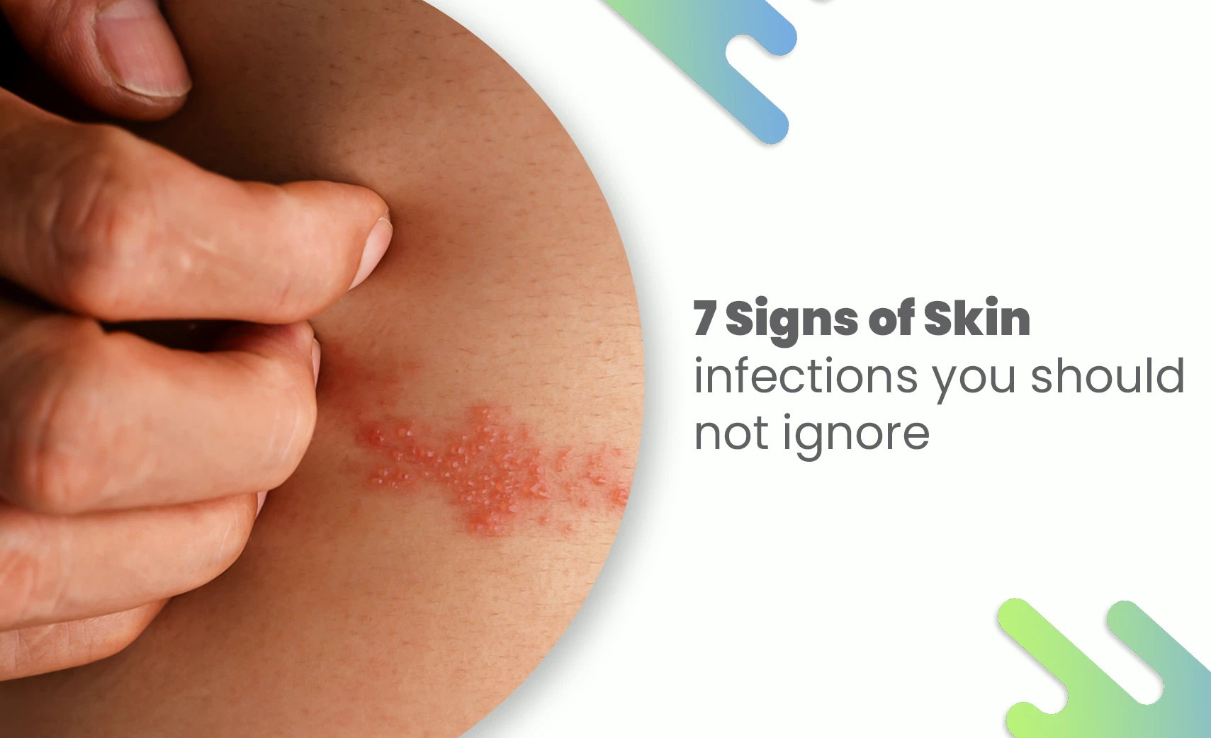 7 Signs of Skin Infections You Should Not Ignore